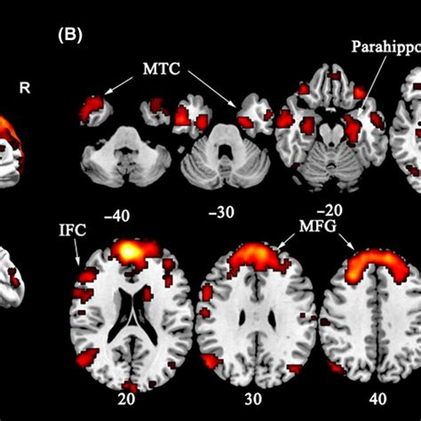 Voxelwised Spatial Map SM Comparisons Of DMN Between HCs And RHZ Download Scientific Diagram