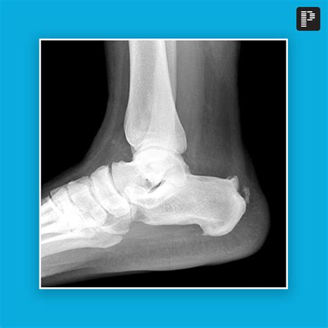 A 58 Year Old Active Male Came Into Prepladder Medical Facebook