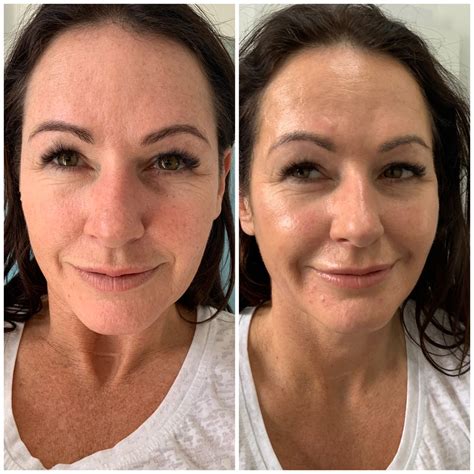 Profhilo Treatment For Face And Body Exeter Devon