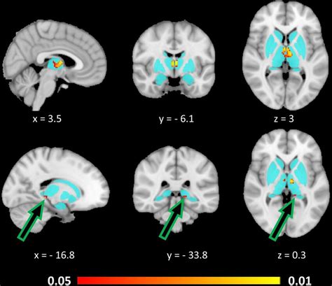 Morphometric Alterations Based On Signal Reductions In C9orf72 Download Scientific Diagram