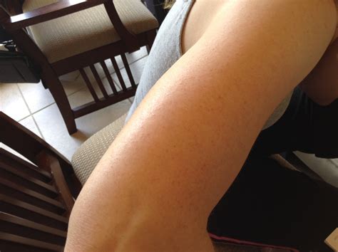 Follicular Hyperkeratosis