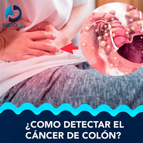Los Síntomas Del Cáncer De Colón Diarrea O Estreñimiento O Un