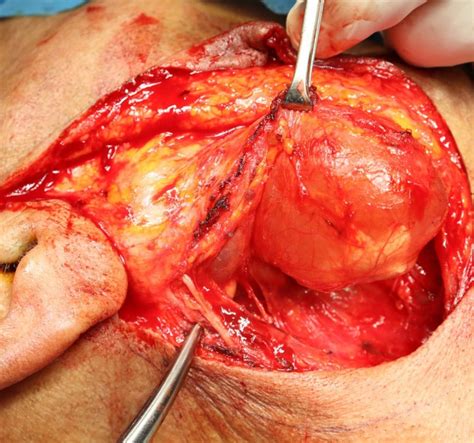 Right Submandibular Mass Oncocytic Cyst Sst