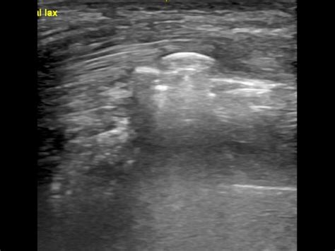Calcaneus Orif With Failed Hardware Affecting Fibularis Tendons Ultrasound Cases