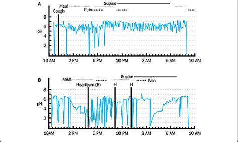 Continuous Ph Monitor Studies A Physiological Reflux B Pathological