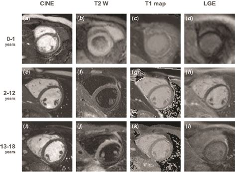 Mid Ventricular Short Axis Slices Demonstrating Cine Imaging Oedema
