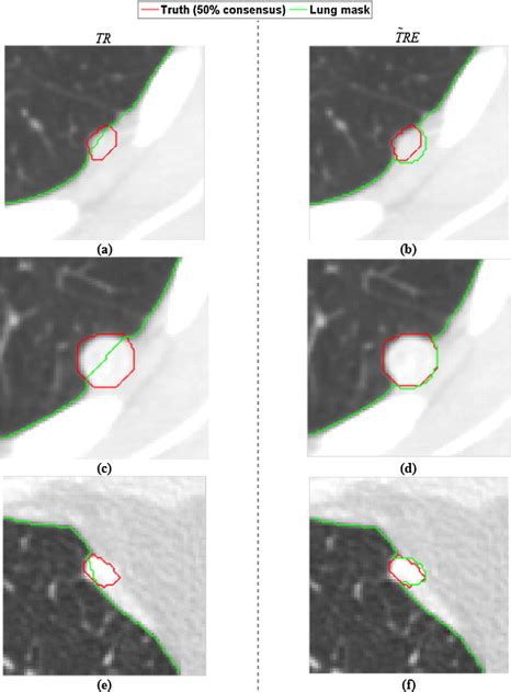 Three Nodules From Lidcidri With Corresponding 50 Consensus Truth Download Scientific