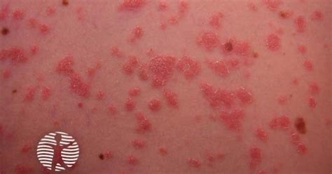 Guttate Psoriasis Image