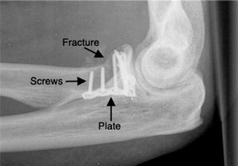 2 Internal Fixation Of The Proximal Radius Adapted From Ring 2008
