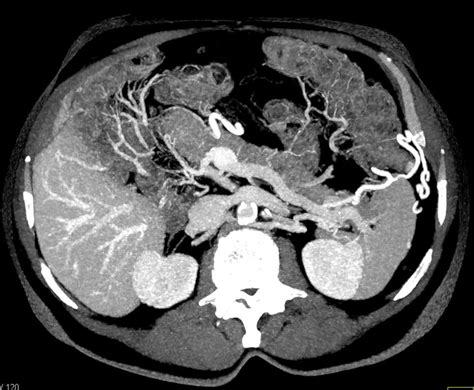 Small Pancreatic Intraductal Papillary Mucinous Neoplasm (IPMN ...