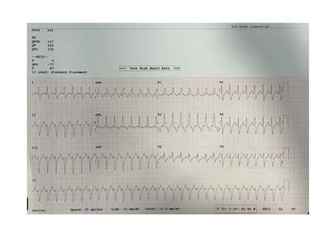 Svt Pediatric Pdf