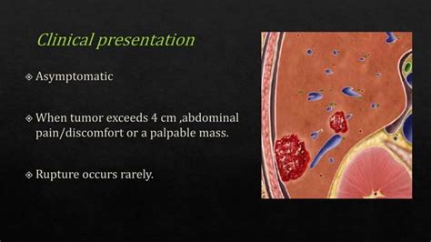 Imaging Of Benign Focal Hepatic Lesions Pptx