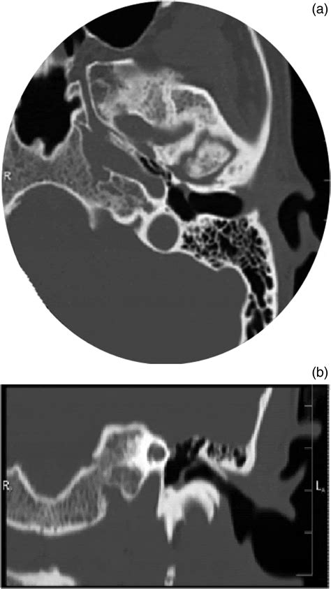 Inflammatory Cast Of The Tympanic Membrane After Acute Otitis Media The Journal Of Laryngology