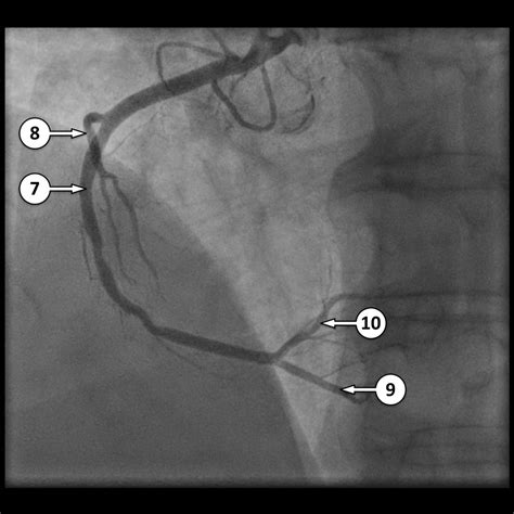 Right Coronary Artery Coronary Angiogram Diagram Quizlet