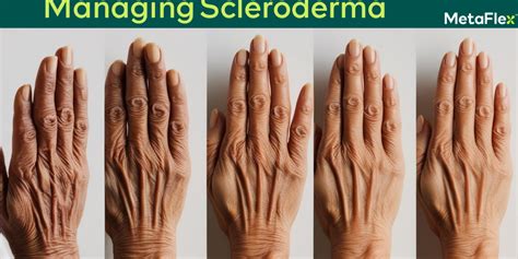 Managing Scleroderma Of The Hands With The Metaflex Glove A Pdac Appr Managing Scleroderma Of The Hands With The Metaflex Glove A Pdac Appr