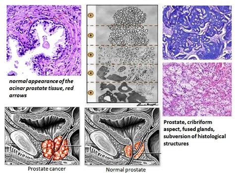 Prostate Cancer Histology Metastatic Prostate Adenocarcinoma To The