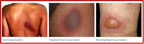 Drug Rashes Emottawa Blog