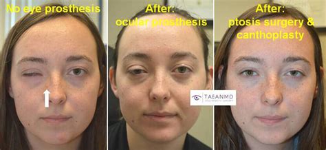 Prosthetic Eye Surgery
