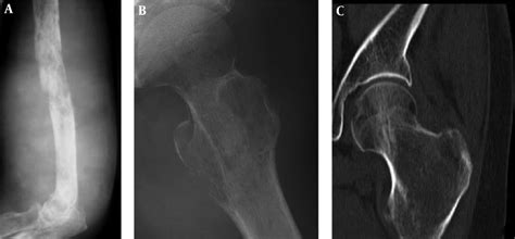 Infiltrative And Osteolytic Destruction A Infiltrative Bone Download Scientific Diagram
