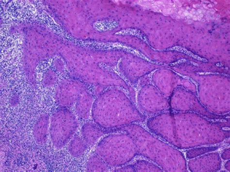 High Power View Showing The Infiltrating Nests Of Atypical Squamoid Download Scientific Diagram