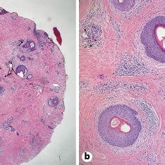Scalp Biopsy From Case A B No Active Inflammation With Preserved Download Scientific