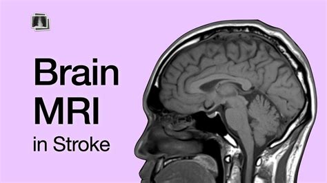 Mr Imaging In Acute Stroke Basics Youtube