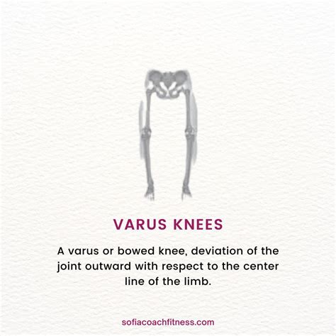 Valgus And Varus Knees
