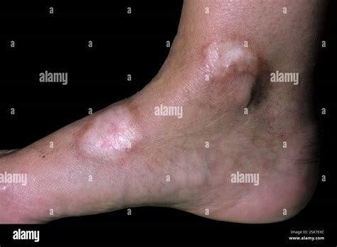 Scleroderma Lesions On The Foot Of A 39 Year Old Man Scleroderma Is A Chronic Autoimmune