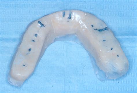 Occlusal Contacts In Nocturnal Splint Download Scientific Diagram