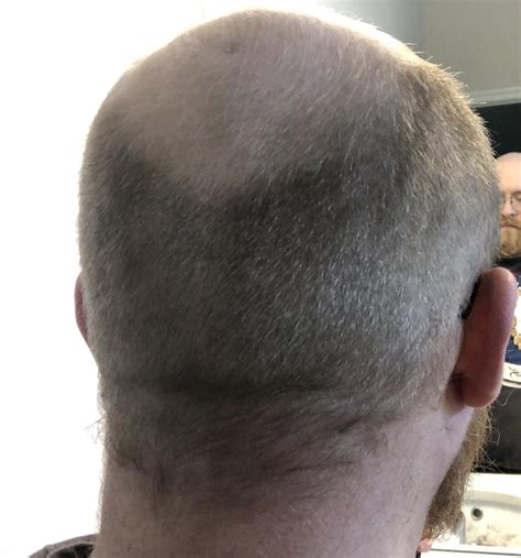 What Do You Think Only 18 And Fully Bald 🥲 R Bald