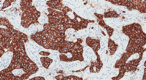 Her2 Mypathologyreport