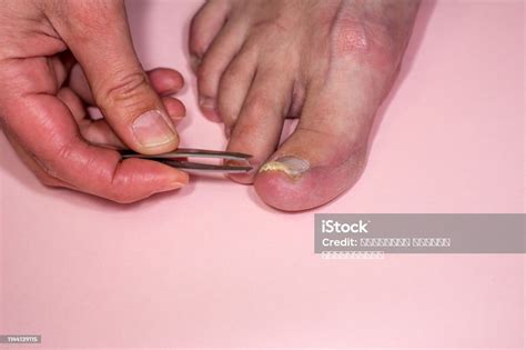 분홍색 배경에 고립 된 손 발톱 손톱 판에 기계적 손상 쉘 락 또는 젤 바니시 를 바른 후 손톱 손상 건강관리와 의술에 대한 스톡 사진 및 기타 이미지 Istock