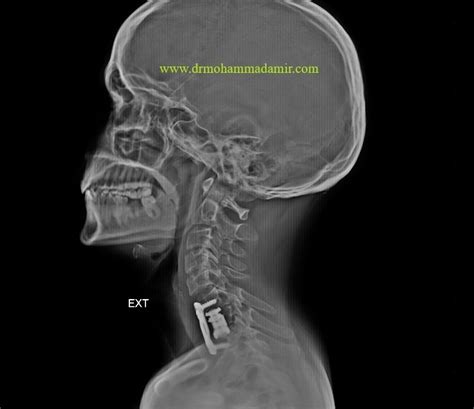 Dr Mohammad Amir Mbbs Ms Mch Neurosurgery C7 Corpectomy With C6 T1 Fixation