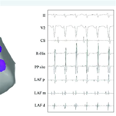 Mapping Along The Laf And Lpf During Narrow Vt Case 2 Download