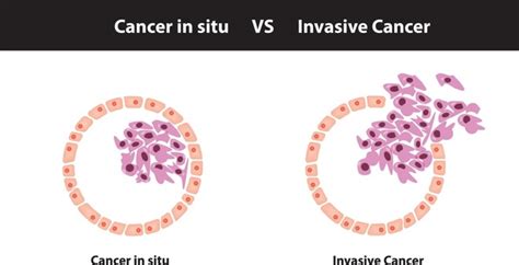 Breast Tissue Progress Over 2 Royalty Free Licensable Stock Vectors And Vector Art Shutterstock