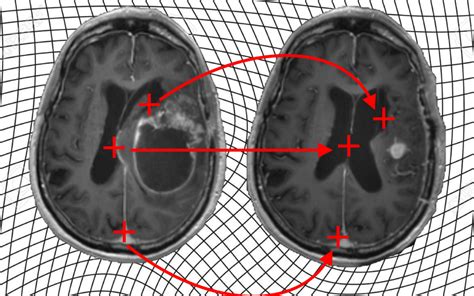 Brain Tumor Mri