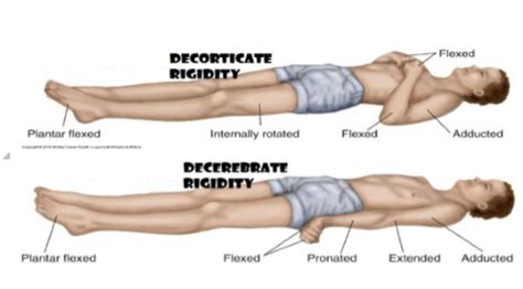Module 11 Interventions For Hypertonia Spasticity And Rigidity Flashcards Quizlet