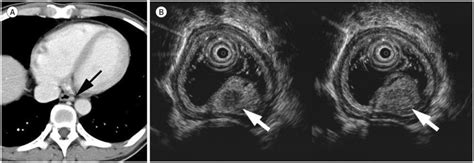 Findings Of Endoscopic Us And Ct Of Esophageal Disease Pmc
