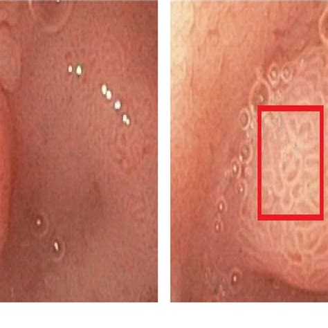 restoration effect of criminisi algorithm when d p 1 a original