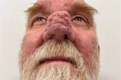 Mans Incredible Transformation After Nose Growth Stopped Him Leaving