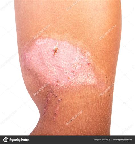 Cow Parsnip Burns Treatment