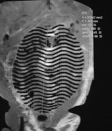 Mesh Surface Area Was Measured On A Reconstructed Coronal Mm Thick Download Scientific
