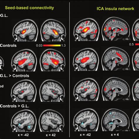 Resting State Functional Connectivity Of The Right Insula A Left Download Scientific