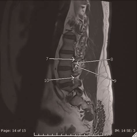 7 Pedicle 8 Fat Within Neural Exit Foramen 9 Exiting Nerve Root