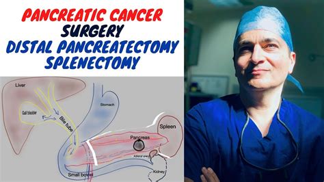 Distal Pancreatectomy Splenectomy Pancreatic Cancer Surgery Youtube
