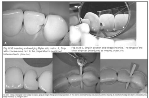 Class Iii Composite Resin Restoration Conservative And Extensive Flashcards Quizlet Class Iii Composite Resin Restoration Conservative And Extensive Flashcards Quizlet