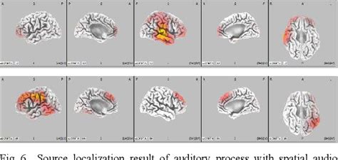 Figure 6 From Quantitative Eeg Analysis Based On Psd And Eloreta Source