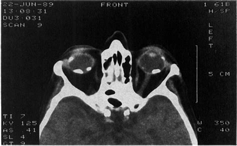 Ct Of Scleral Plaques