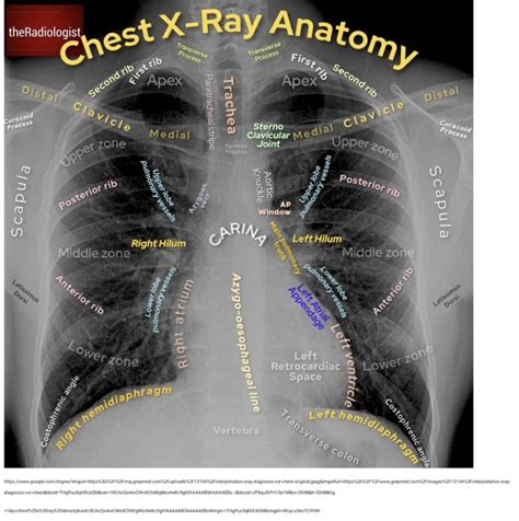 흉부 엑스레이 보는 법 폐렴xray 네이버 블로그