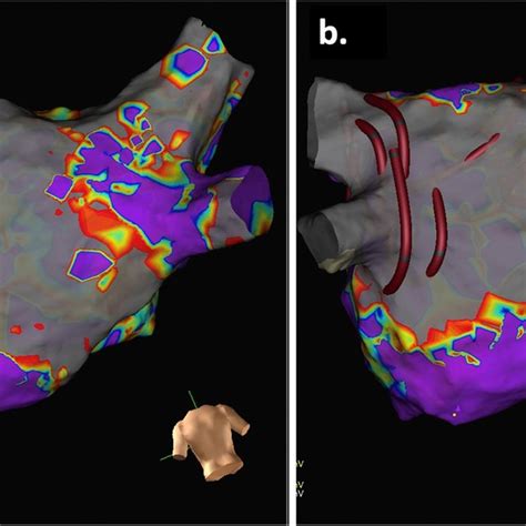 A Three Dimensional Electroanatomic Voltage Map Of The La Download